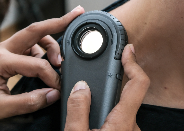 Dermoscopy: The Superior Tool for Skin Diagnosis, Illuco's Dermatoscop