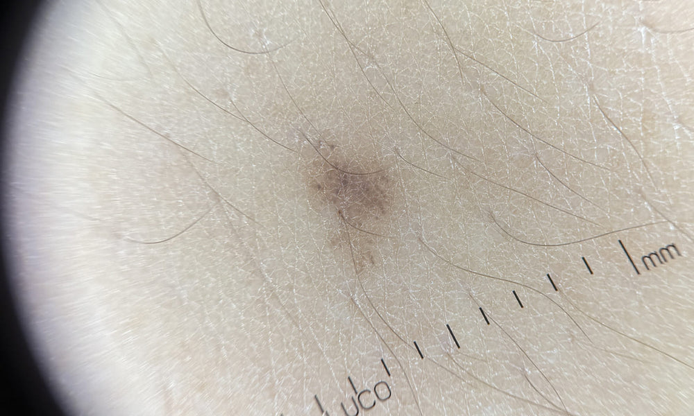 Dermatoscopes | High-Definition Polarized Skin Diagnostics